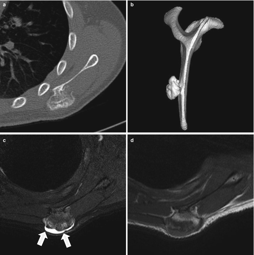 Pediatric Bone Tumors | SpringerLink