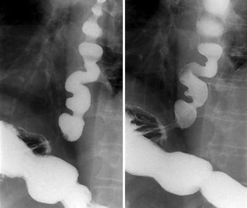 Dysfunctional Disorders of the Pharynx and the Esophagus: VFSS and ...