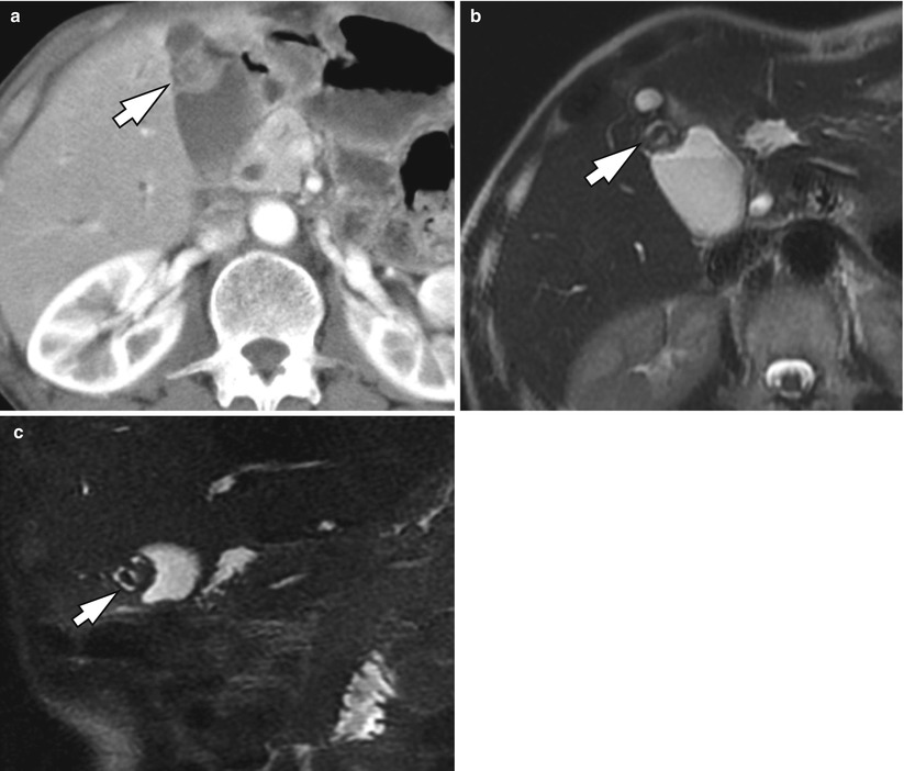 Cholecystitis and Adenomyomatosis | SpringerLink