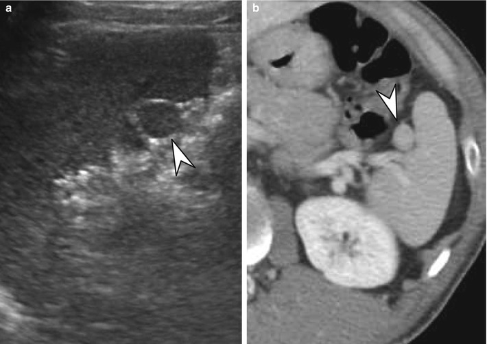 Anomalies and Anatomic Variations of the Spleen | SpringerLink