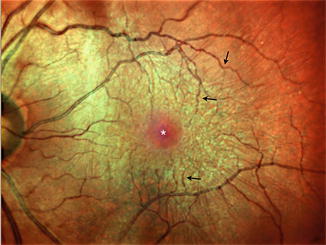 Cellophane Maculopathy | SpringerLink