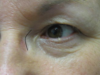 Lynch Incision, for Anterior Orbitotomy | SpringerLink