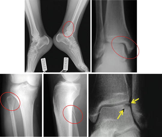 Distal Tibiofibular Syndesmotic Disruption (High Ankle Sprain): Missed ...