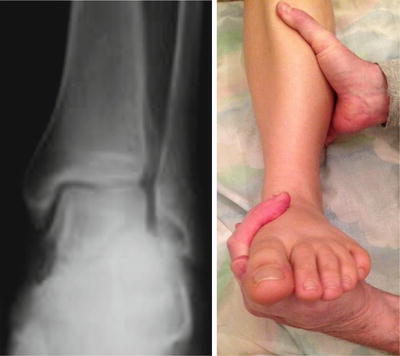 Distal Tibiofibular Syndesmotic Disruption (High Ankle Sprain): Missed ...