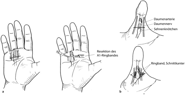 Nervenkompressionssyndrome | SpringerLink