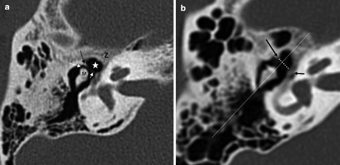 Middle Ear Compartments | SpringerLink