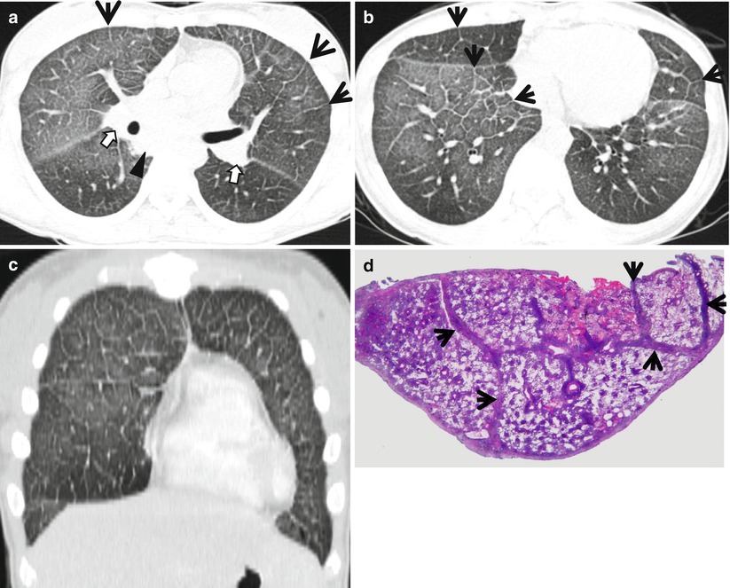 Interlobular Septal Thickening | SpringerLink