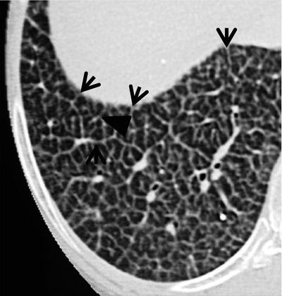 Interlobular Septal Thickening | SpringerLink