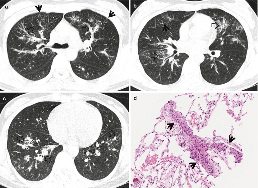 Interlobular Septal Thickening | SpringerLink