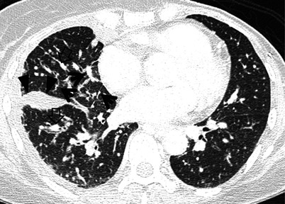 Interlobular Septal Thickening | SpringerLink