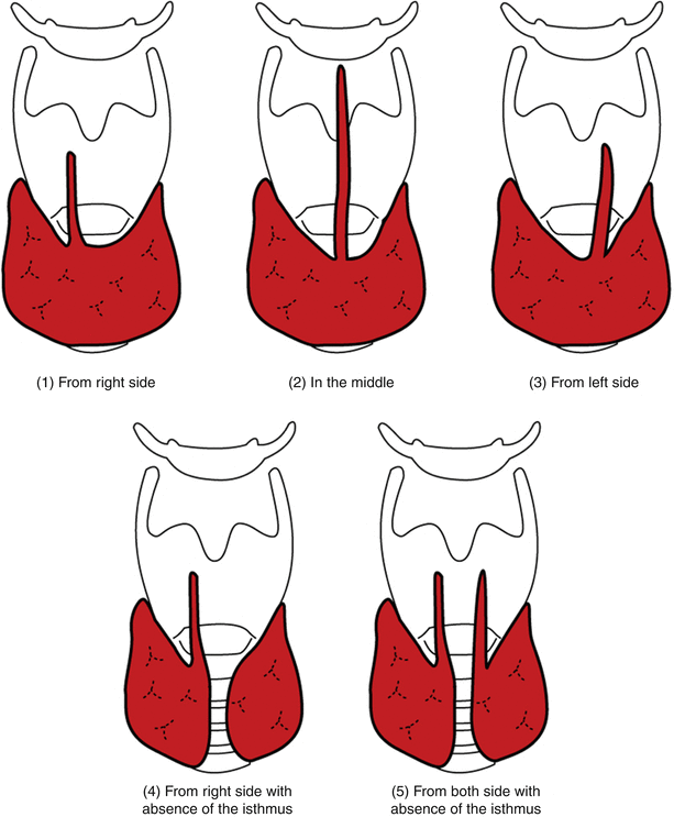 Open Thyroidectomy | SpringerLink