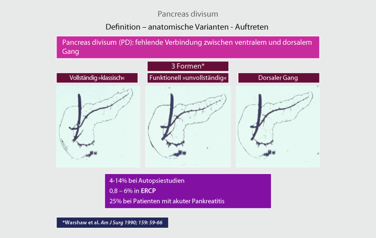 Pancreas divisum: Wann ist eine operative Therapie indiziert ...