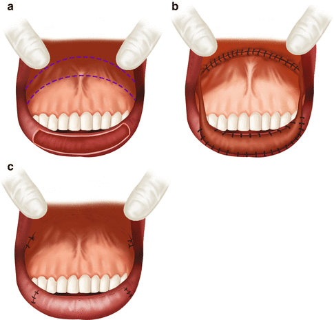 Reconstruction of Complex Lip Defects | SpringerLink