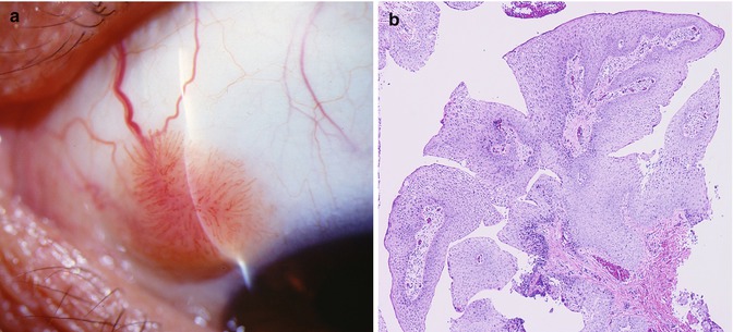 Conjunctival and Corneal Tumors: Benign Epidermal and Melanocytic ...