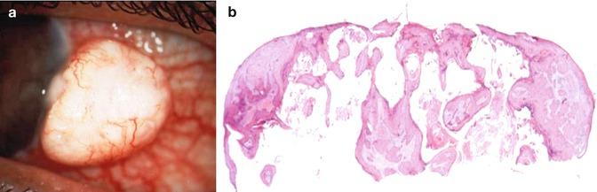Conjunctival and Corneal Tumors: Benign Epidermal and Melanocytic ...