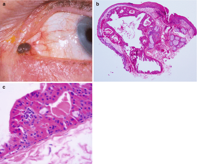 Caruncular Tumors | SpringerLink