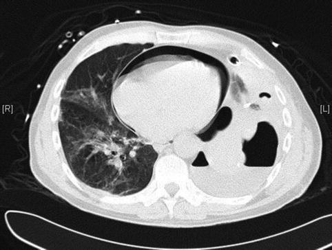 Pericardial Window | SpringerLink