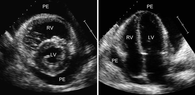 Pericardial Window | SpringerLink