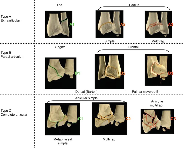 Distal Radius Fractures | SpringerLink