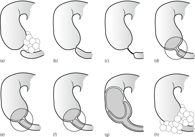 Duodenal Obstruction | SpringerLink