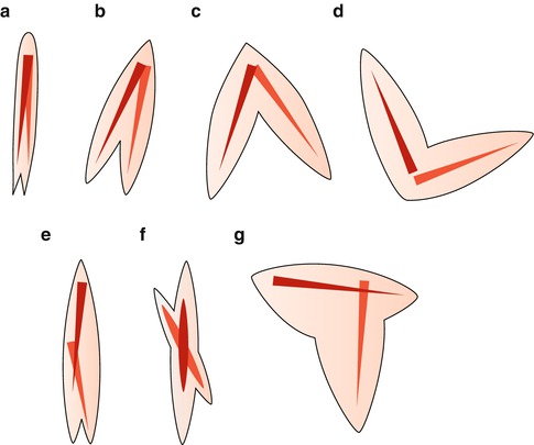 Pointed, Sharp, and Semi-sharp Force Trauma | SpringerLink