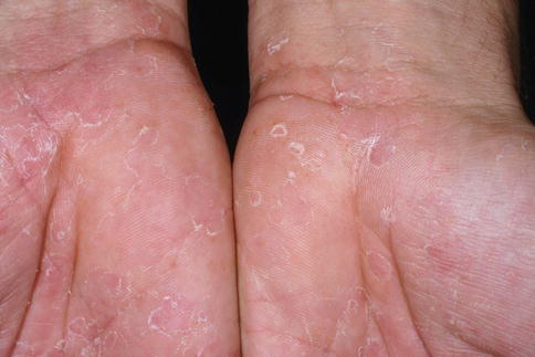 Acute and Recurrent Vesicular Hand Eczema | SpringerLink