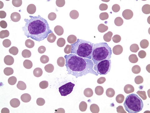B-Cell Prolymphocytic Leukemia (B-PLL) and T-Cell Prolymphocytic ...