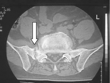 “Construction Plan” of the Bony Pelvis | SpringerLink