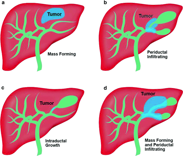 Surgical Management of Intra-Hepatic Cholangiocarcinoma | SpringerLink