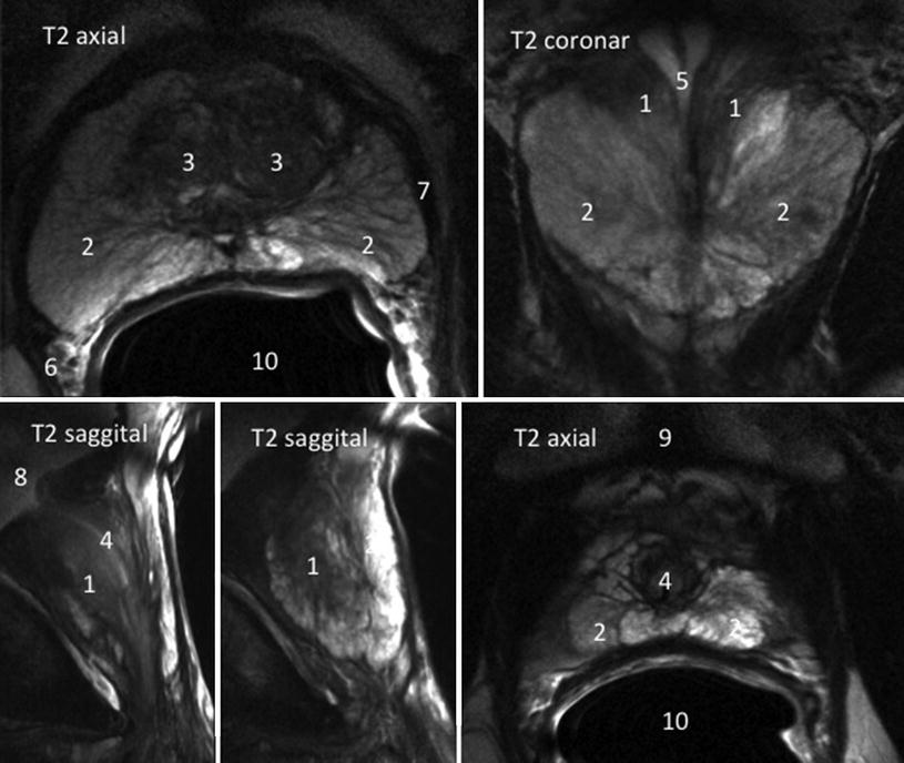 MRT der Prostata | SpringerLink