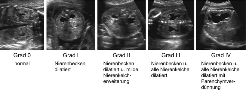 Pränatale Diagnostik in der Urologie | SpringerLink