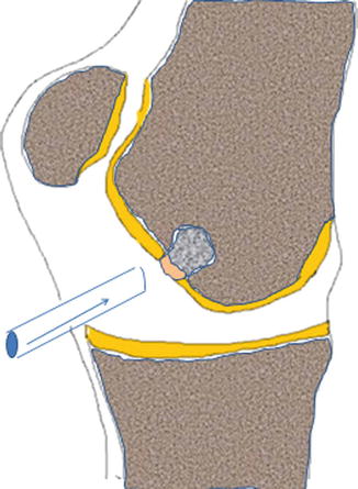 Knee Cartilage Repair with Hyalograft® (Hyaff-11 Scaffold with Seeded ...