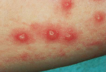 Varizella-Zoster-Viruserkrankungen | SpringerLink