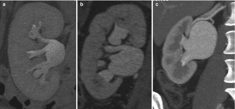 Normal Radiological Anatomy and Anatomical Variants of the Kidney ...