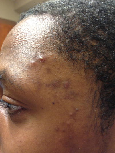 Acne Vulgaris | SpringerLink