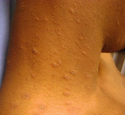 Pityriasis Rosea | SpringerLink