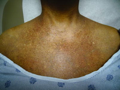 Dermatomyositis | SpringerLink