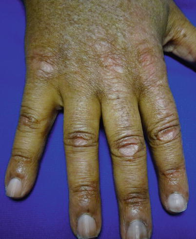 Dermatomyositis | SpringerLink