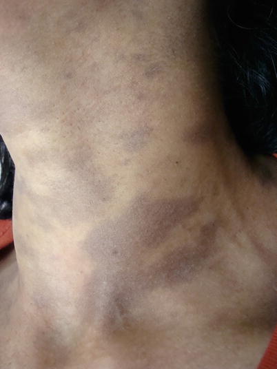 Ashy Dermatosis (Erythema Dyschromicum Perstans) | SpringerLink