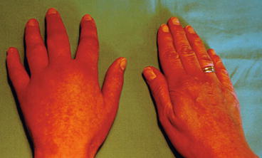 Controversial Pain Syndrome of M. Sudeck (RSD, CRPS I): Pathogenesis ...