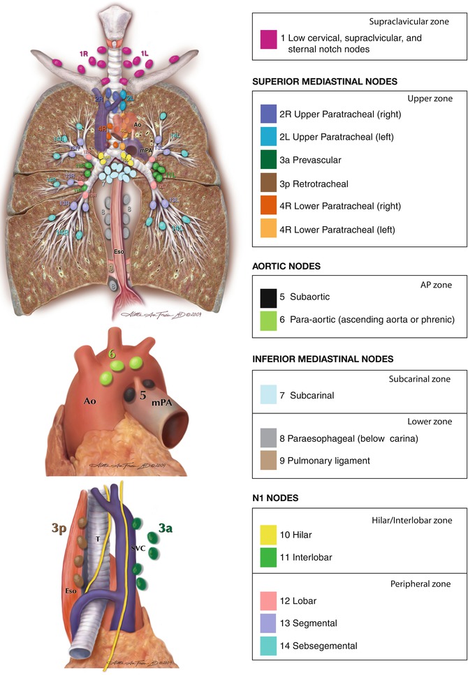 Mediastinoscopy | SpringerLink