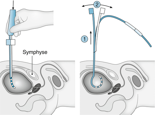 Katheter in der Intensivmedizin | SpringerLink