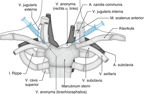 Katheter in der Intensivmedizin | SpringerLink