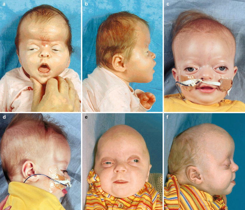 The Neural Crest and Craniofacial Malformations | SpringerLink