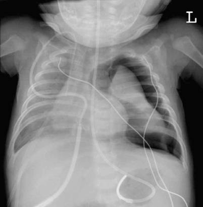 Drainagen in der Intensivmedizin | SpringerLink