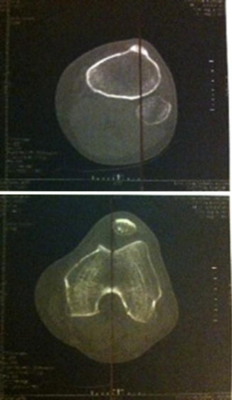 Elmslie-Trillat Procedure: A Distal-Based Procedure for Patellar ...