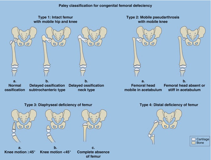 Lengthening Reconstruction Surgery for Congenital Femoral Deficiency ...