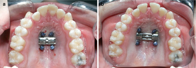 Bone-Anchored Rapid Palatal Expansion | SpringerLink
