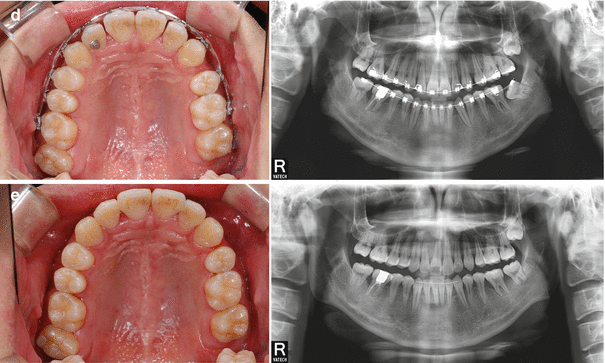 Molar Protraction: Orthodontic Substitution of Missing Posterior Teeth ...