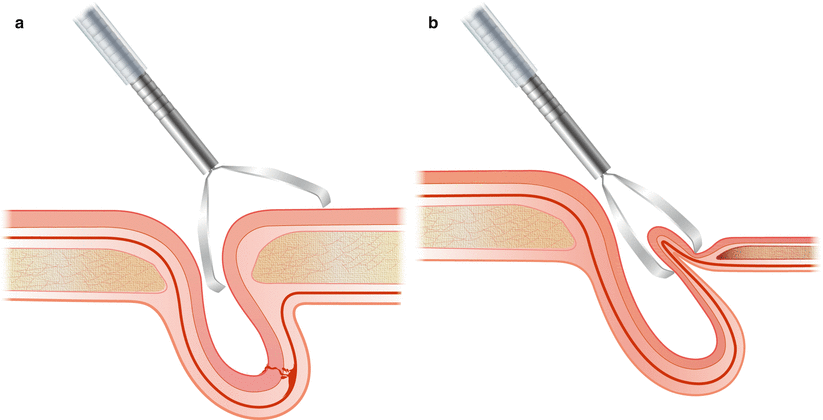 Endoscopic Treatment of Lower Gastrointestinal Bleeding | SpringerLink